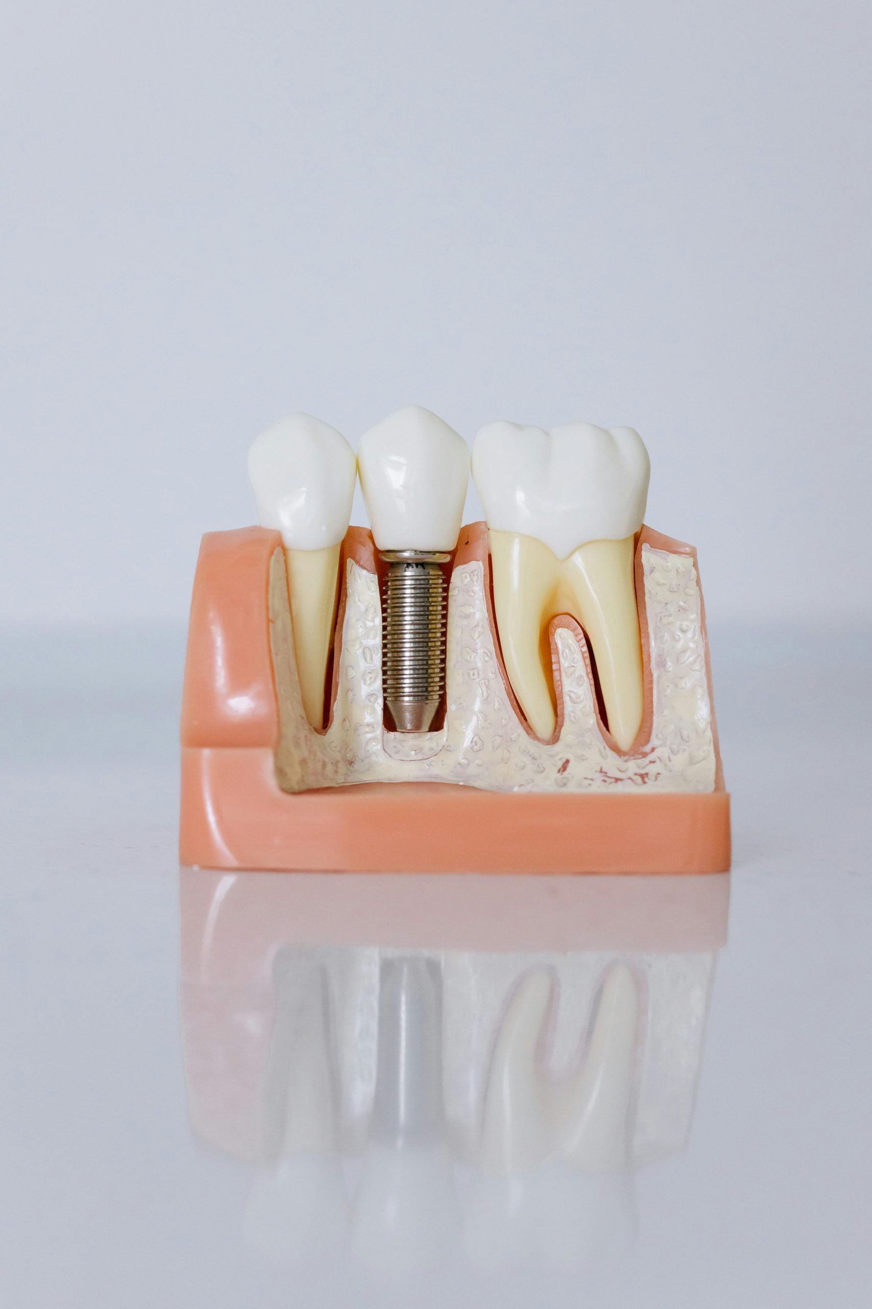 Understanding dental implants: a guide to your options - Learntsh